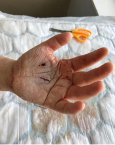 Weiße Haut um die Wunde – wie man Wunden in der Handtherapie pflegt