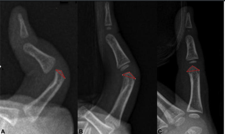 Camptodactyly Stretches | Hand Therapy Academy