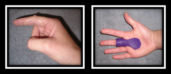 Trigger Finger Orthosis Treatment | Hand Therapy Academy