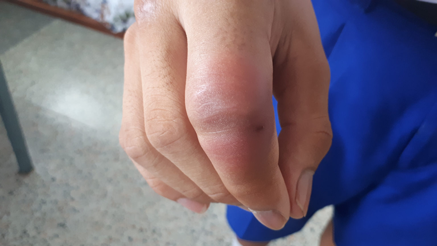 Las mejores técnicas de manejo de edemas en terapia de manos