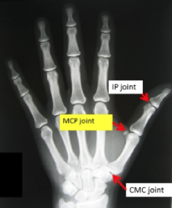 Sesamoid Bone Hand Therapy | What are sesamoid bones for?
