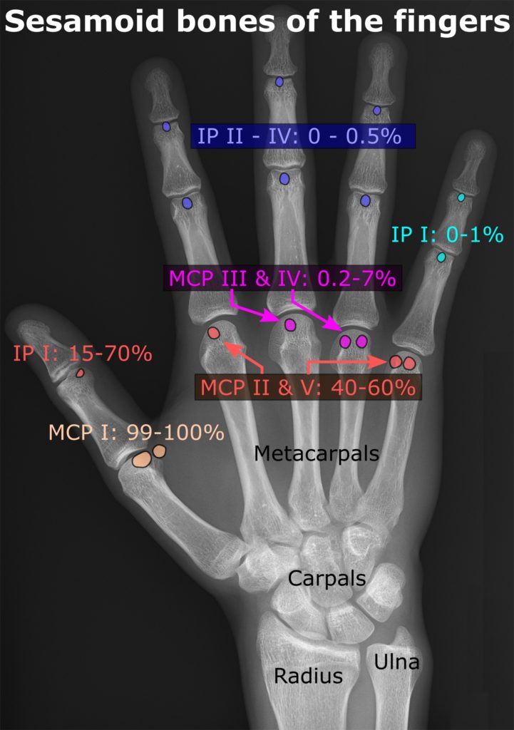 Sesamoid Bones: What are they and what do they do? | Hand Therapy Academy