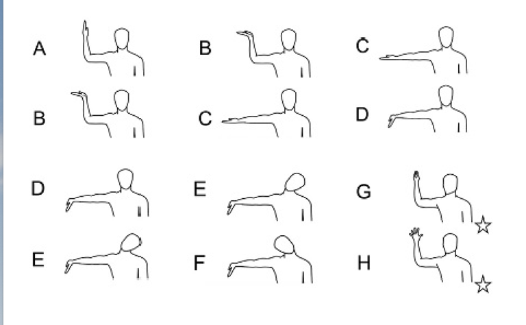 A New Type of Median Nerve Glides for Carpal Tunnel Syndrome