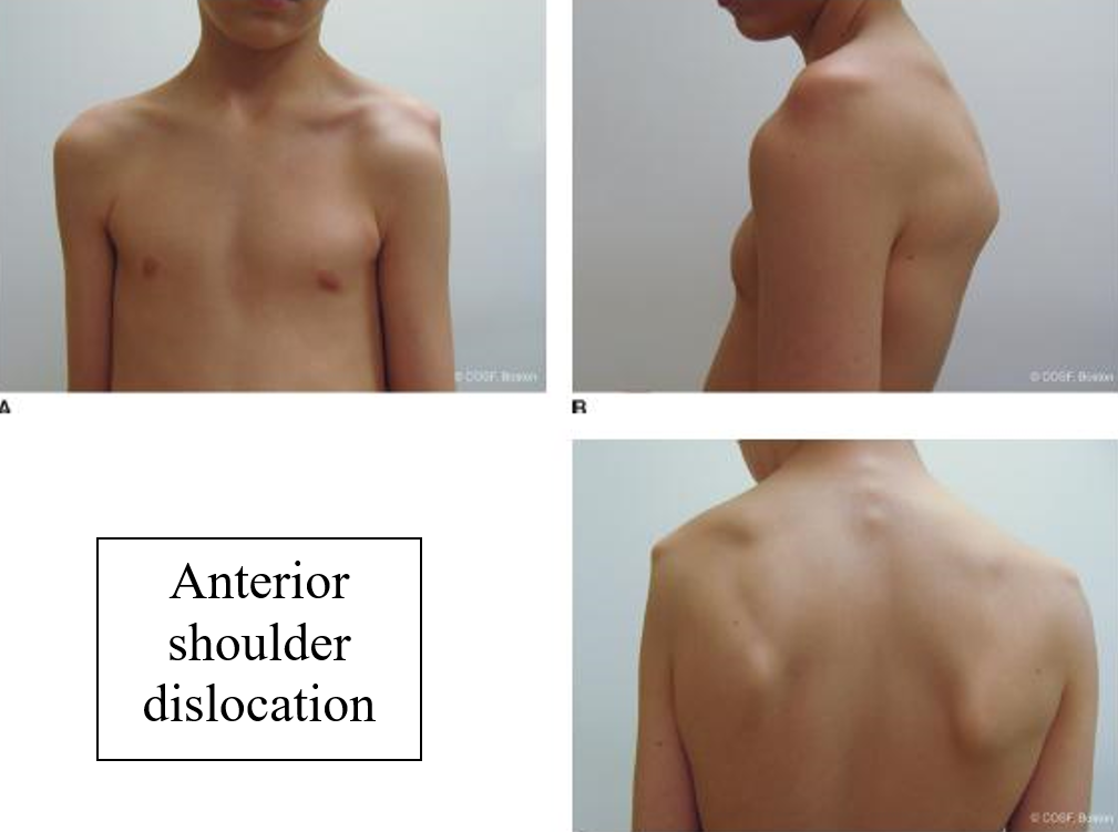 Anterior Shoulder Instability Hand Therapy Article Review