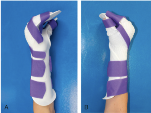 Orthotic Options for Hand Burns | Palmar Extension Splint