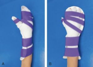 Orthotic Options for Hand Burns | Palmar Extension Splint
