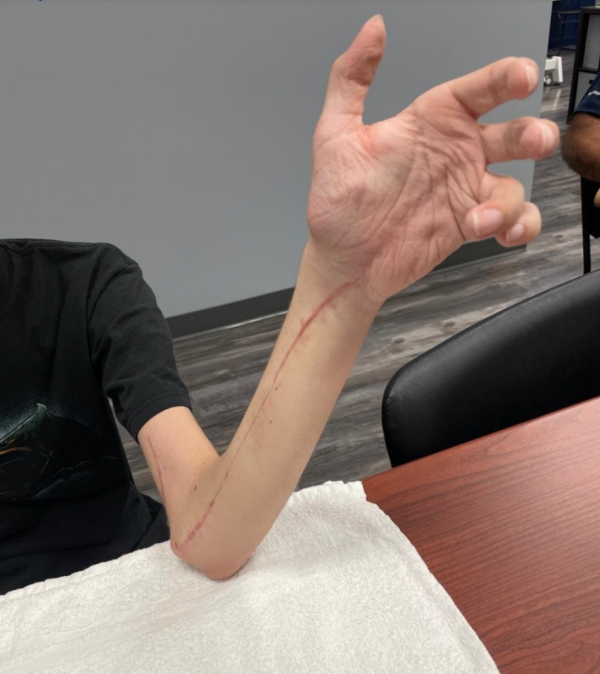 Arteriovenous Malformation Avm Hand Hand Therapy Academy