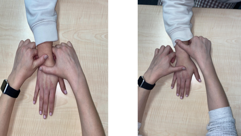 Managing UE Edema in Hand Therapy | Hand Therapy Academy