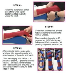 Hand Therapy Splinting | Hand Therapy Academy