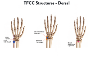 Ulnar Sided Wrist Pain | Hand Therapy Academy