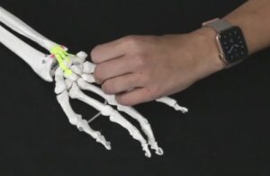 Ulnar Sided Wrist Pain | Hand Therapy Academy