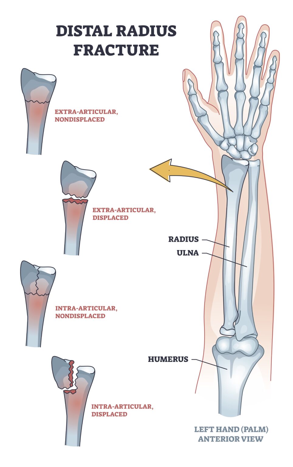Différents types de fractures du radius distal observés dans la ...