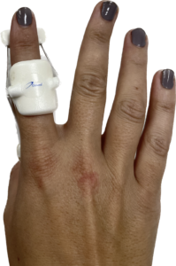 What are the splinting options for stiff finger joints?