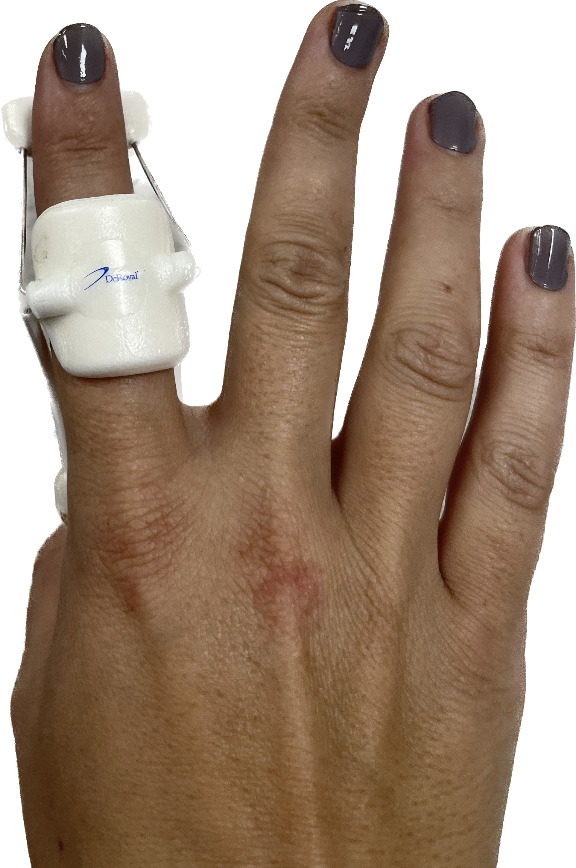 What are the splinting options for stiff finger joints?
