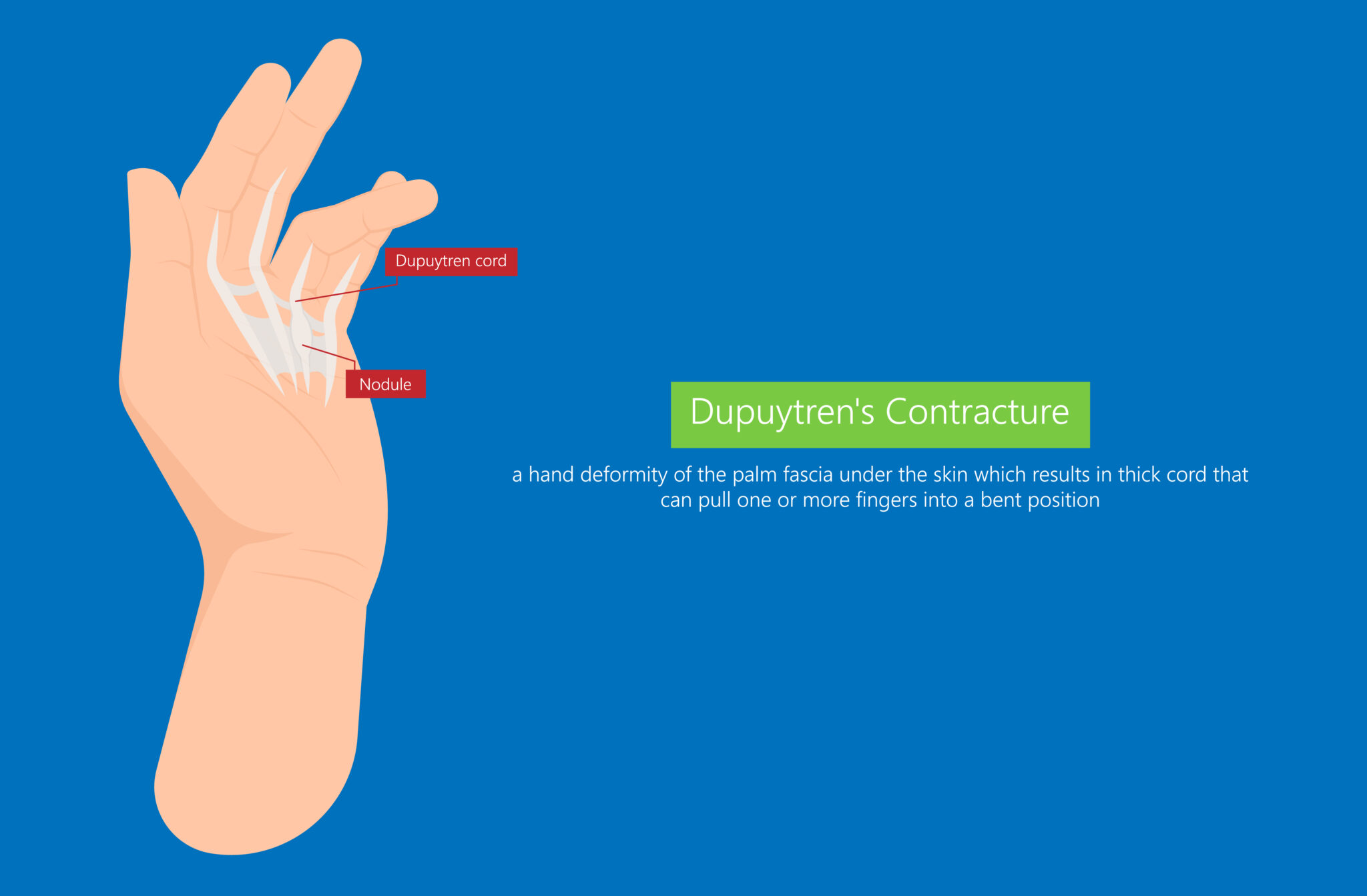 Injection vs fasciotomy for Dupuytren’s contracture