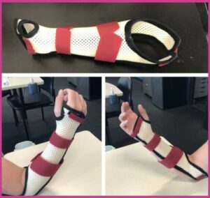 Elbow LCL Treatment | Hand Therapy Academy