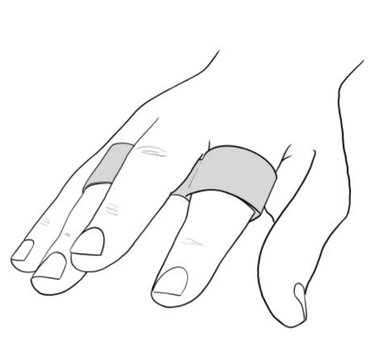 relative motion orthosis for extensor tendon