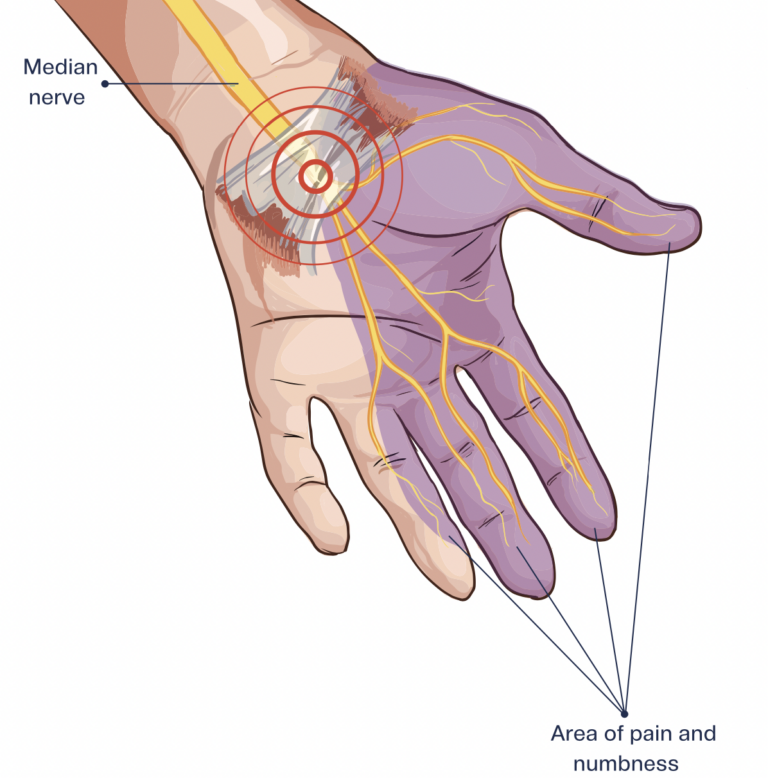 Pillar Pain After Carpal Tunnel Release Surgery