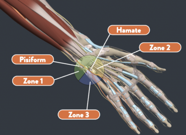 Handlebar Palsy also known as Ulnar Nerve Compression | Hand Therapy ...