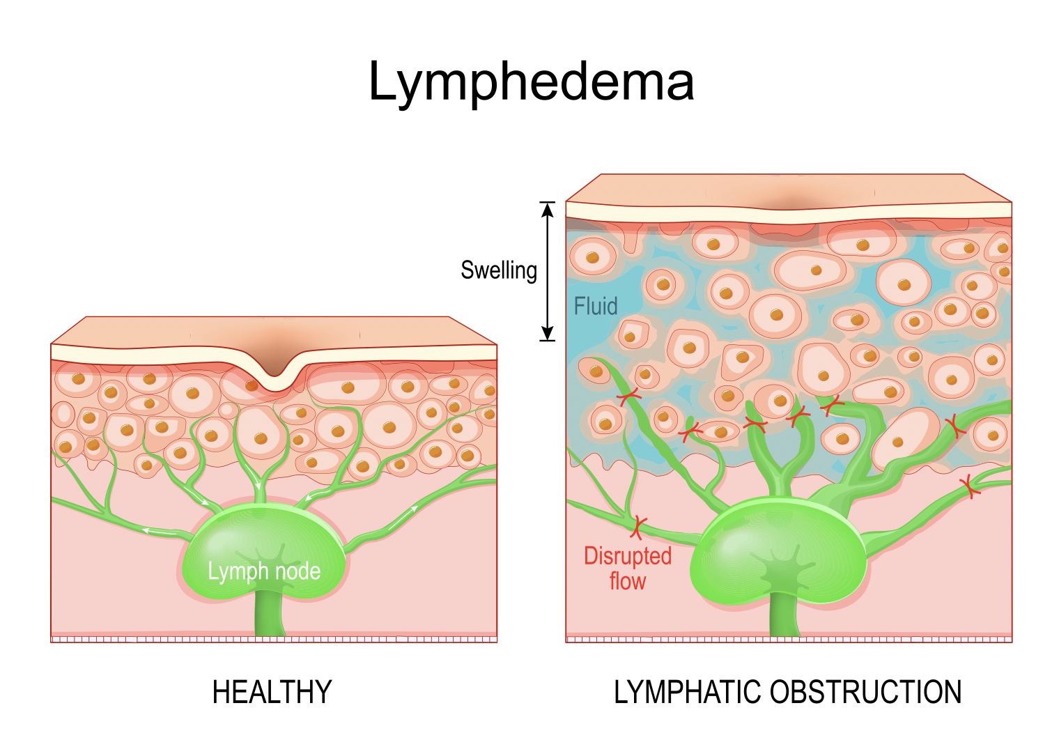 Vergleich von Ödemen und Lymphödemen: Unterschiede in der Handtherapie