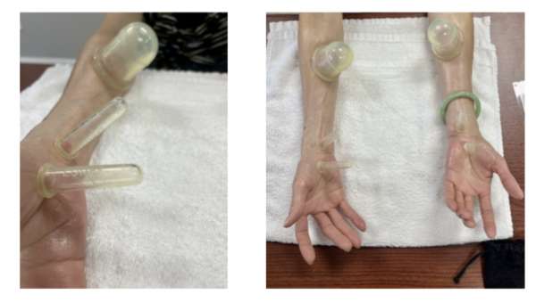Therapeutic Interventions and Contraindications of Cupping