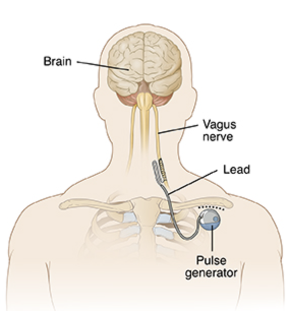 Vagus Nerve Stimulation (VNS) for Various Etiologies | Hand Therapy Academy
