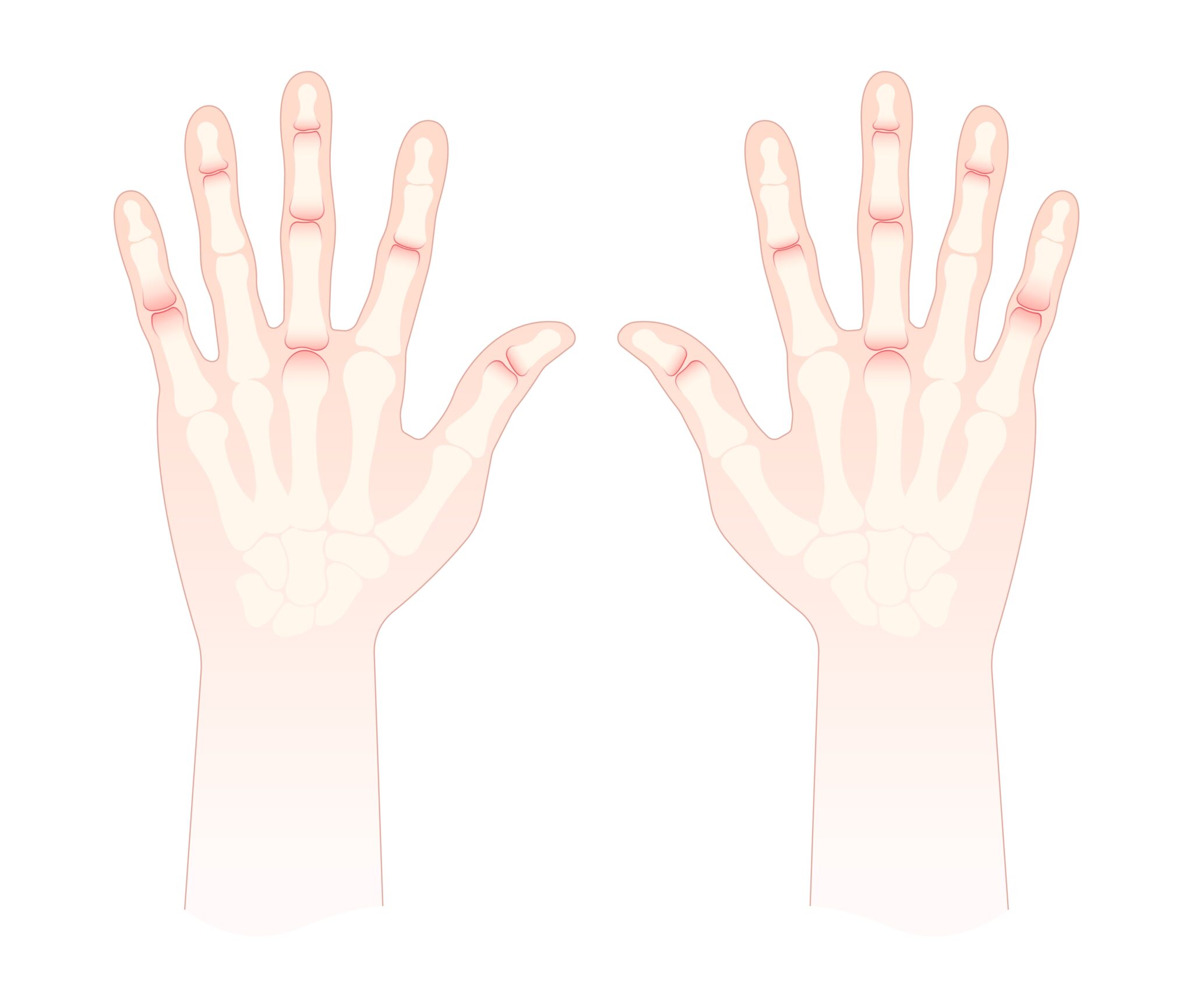 Trigger Finger Sagittal Band Injury Subluxing Lateral Band