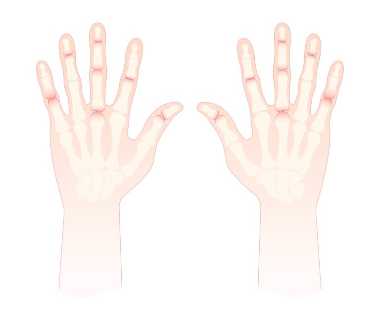 Trigger Finger Sagittal Band Injury Subluxing Lateral Band