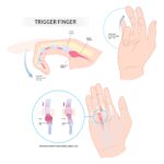 Trigger Finger Sagittal Band Injury Subluxing Lateral Band