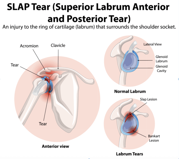 slap tear