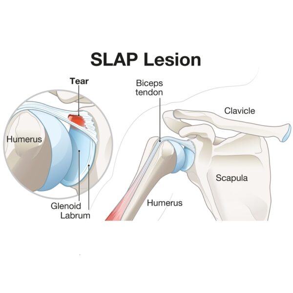 slap tear