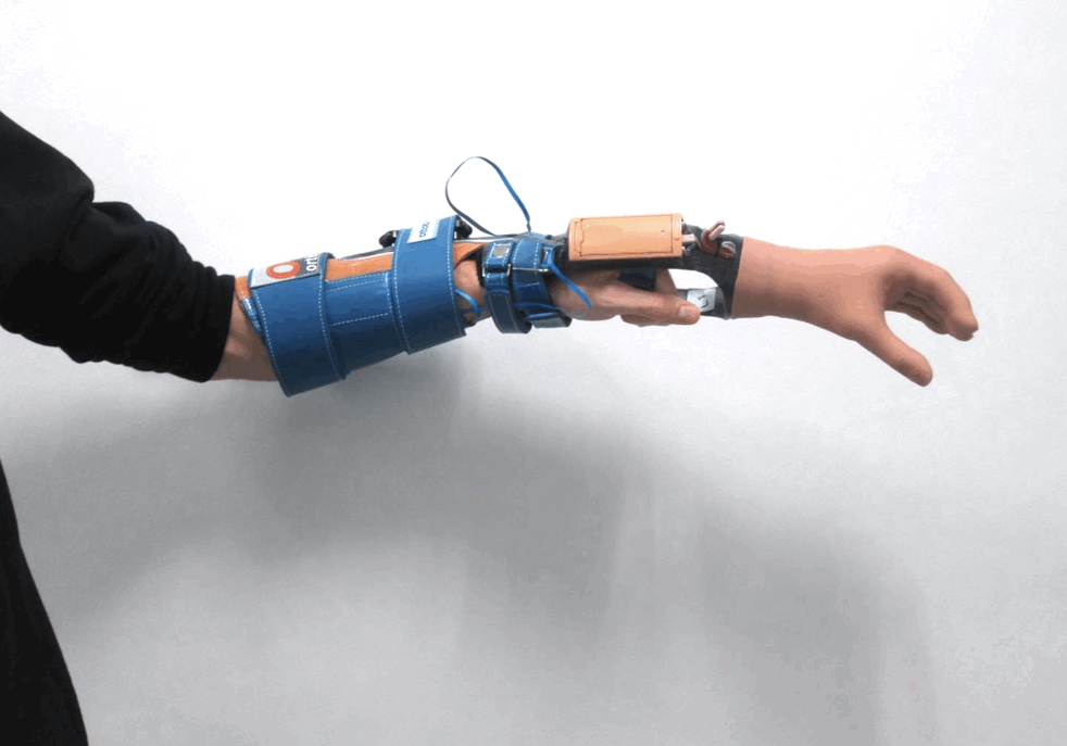 Radial Nerve Palsy: A Paralysis Causing Wrist Drop